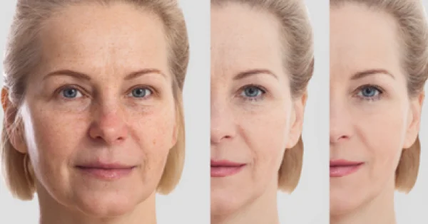 Петна по лицето: как да избегнем пигментацията по кожата?